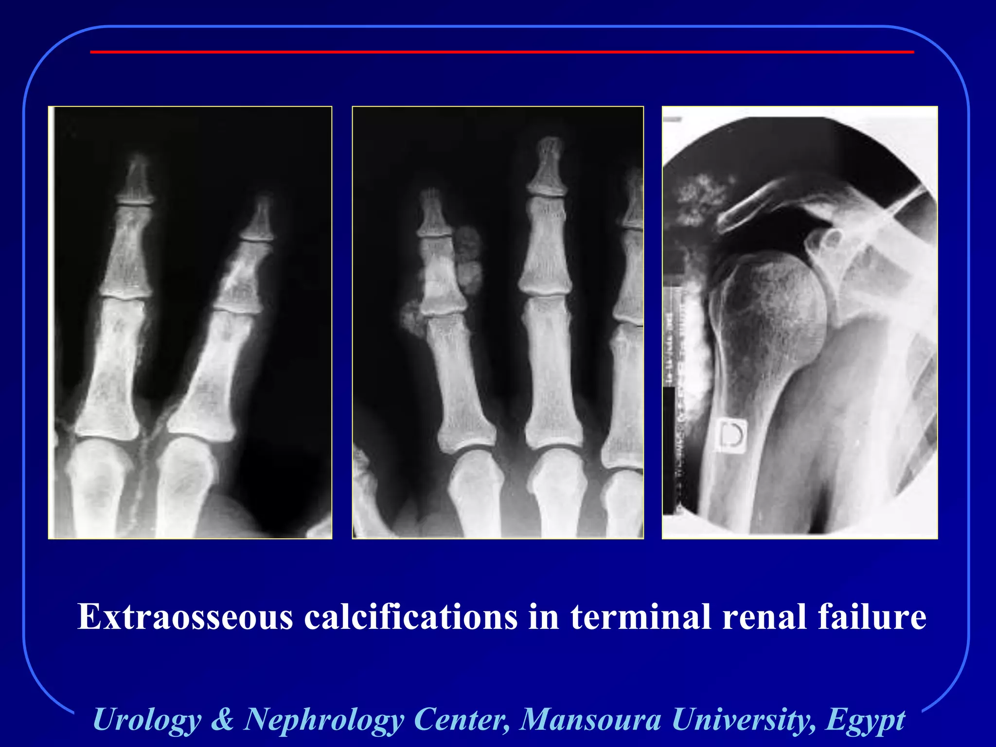 Prof sobh renal osteodystrophy | PPT