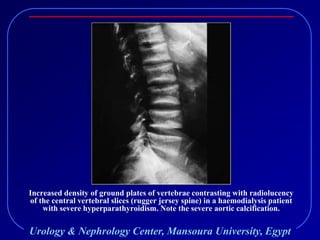 Prof sobh renal osteodystrophy | PPT