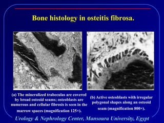 Renal Osteodystrophy Histology