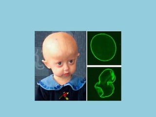 Progeria | PPTX