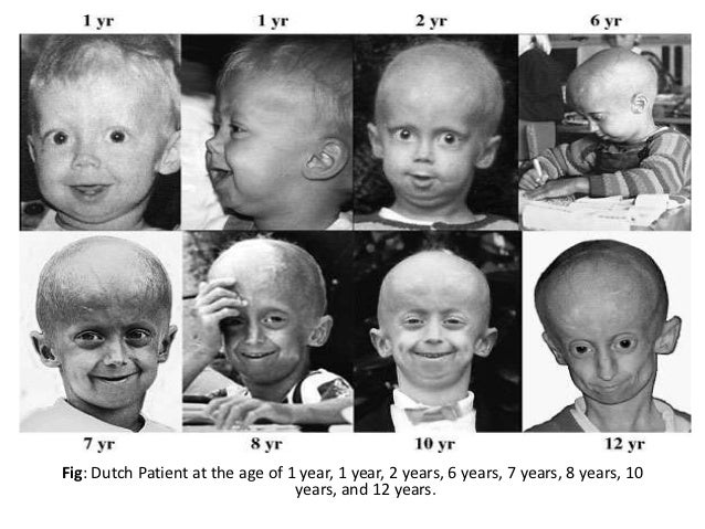 Progeria