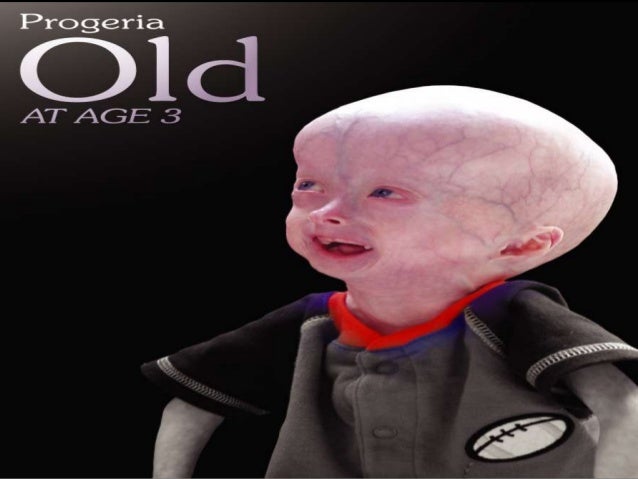 Progeria