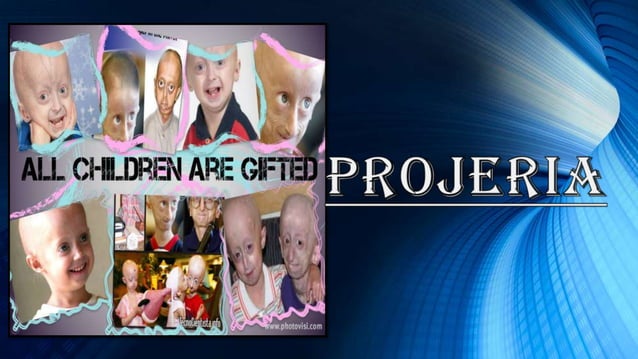 Progeria | PPTX | Genetics | Science