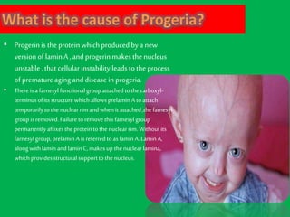 Progeria.2 | PPT