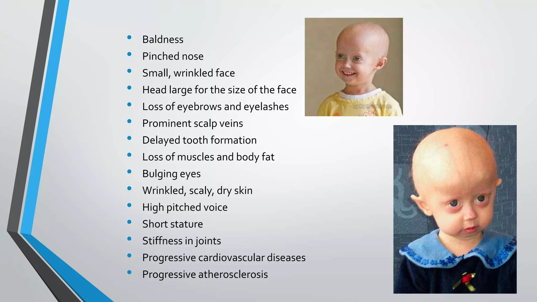 Progeria Syndrome | PPTX