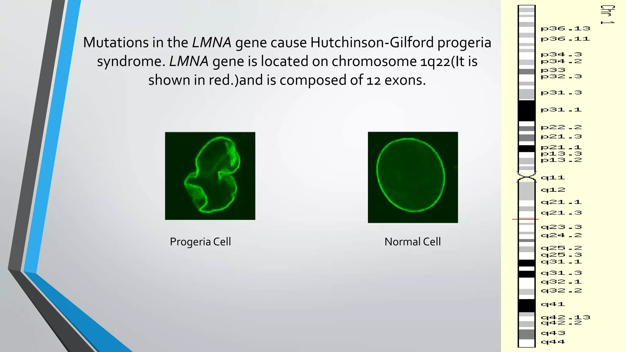 Progeria Syndrome | PPTX