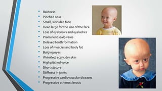 Progeria Syndrome | PPTX