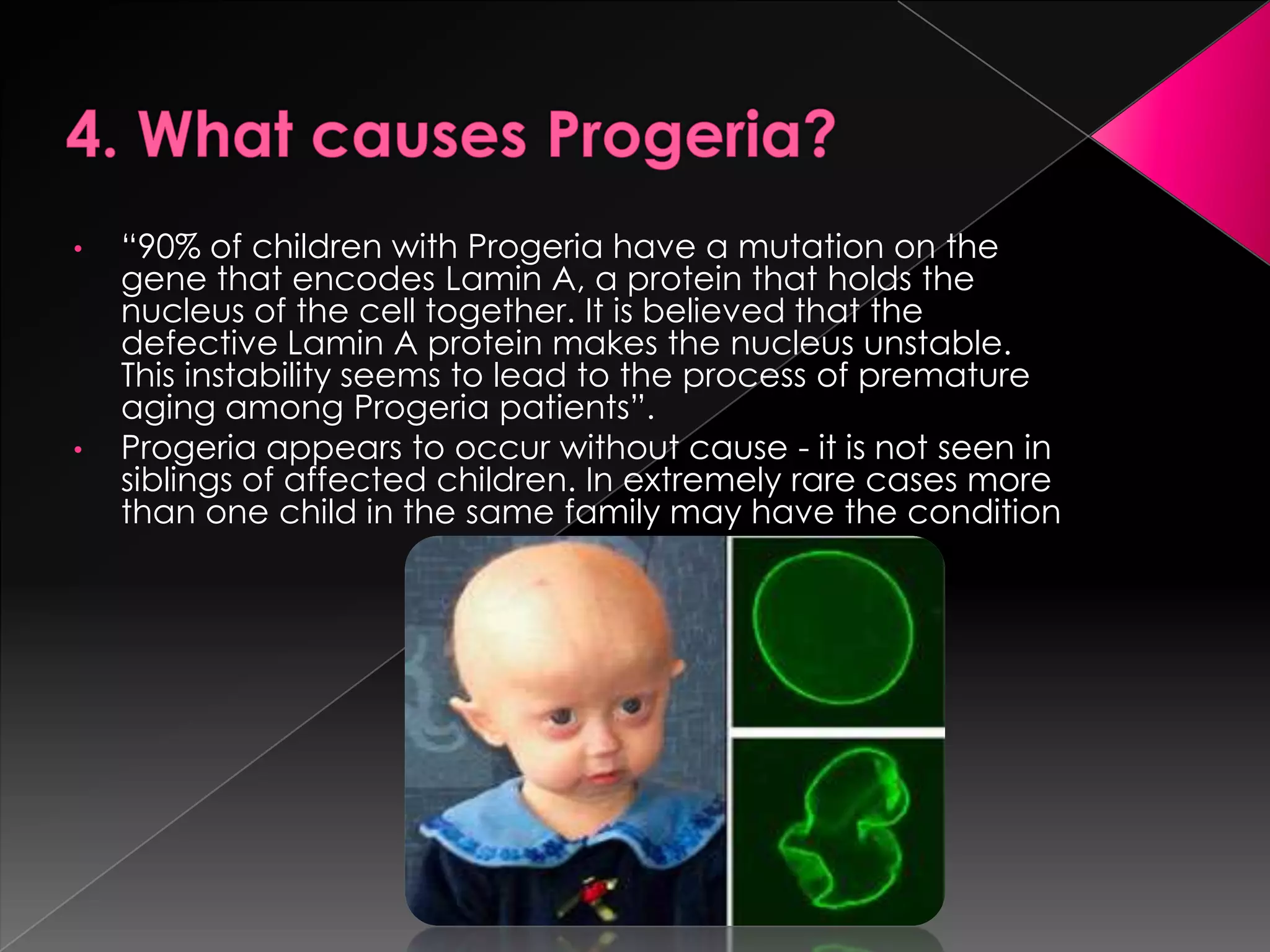 Progeria , by Lucia | PPSX
