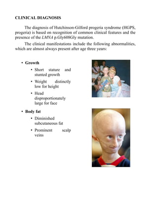 Progeria Syndrome | PDF