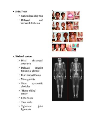 Progeria Syndrome | PDF