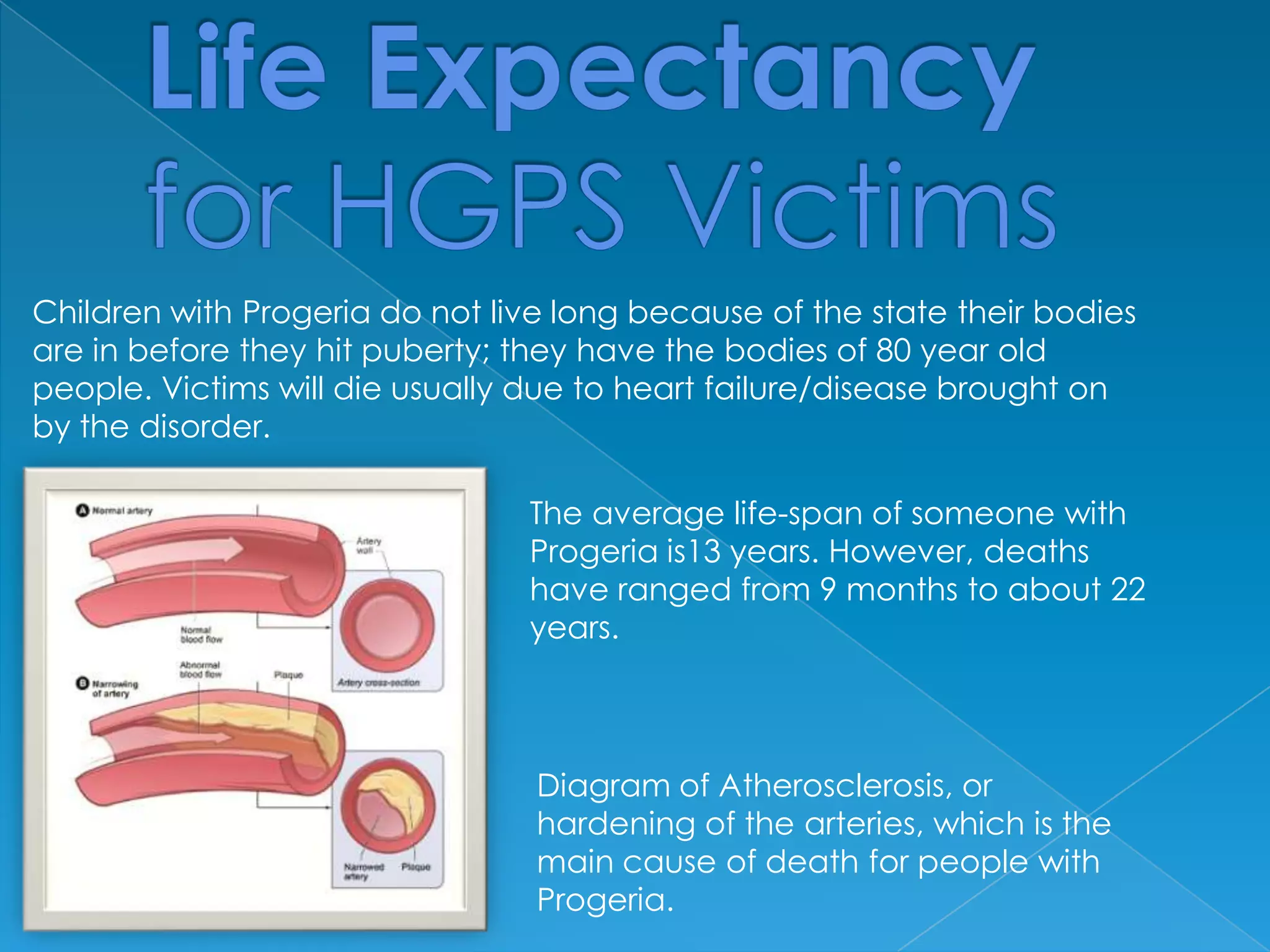 Everything you Need to Know About Progeria | PPTX