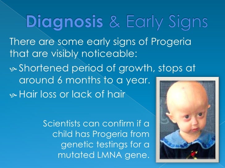 Everything you Need to Know About Progeria