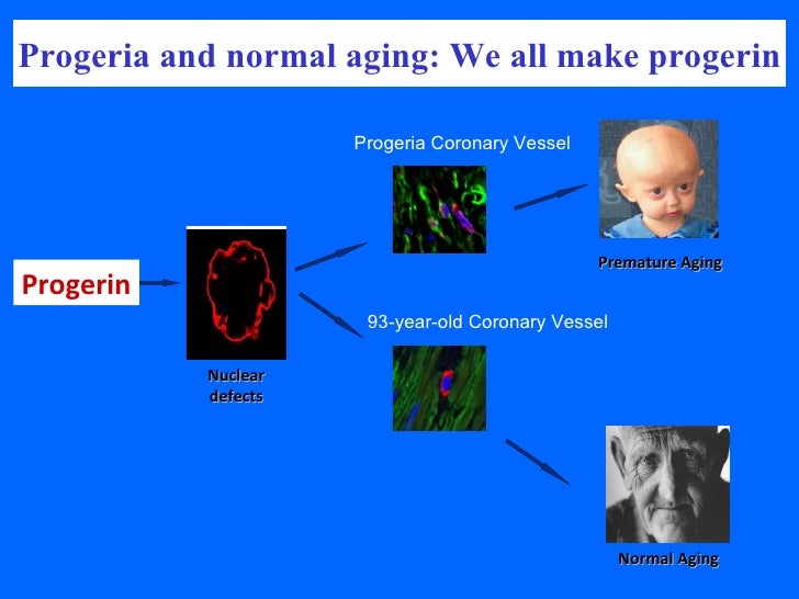 Progeria Research Foundation at Partnering for Cures