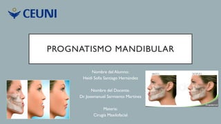 PROGNATISMO MANDIBULAR_HEIDI_EXPOSICION.pptx