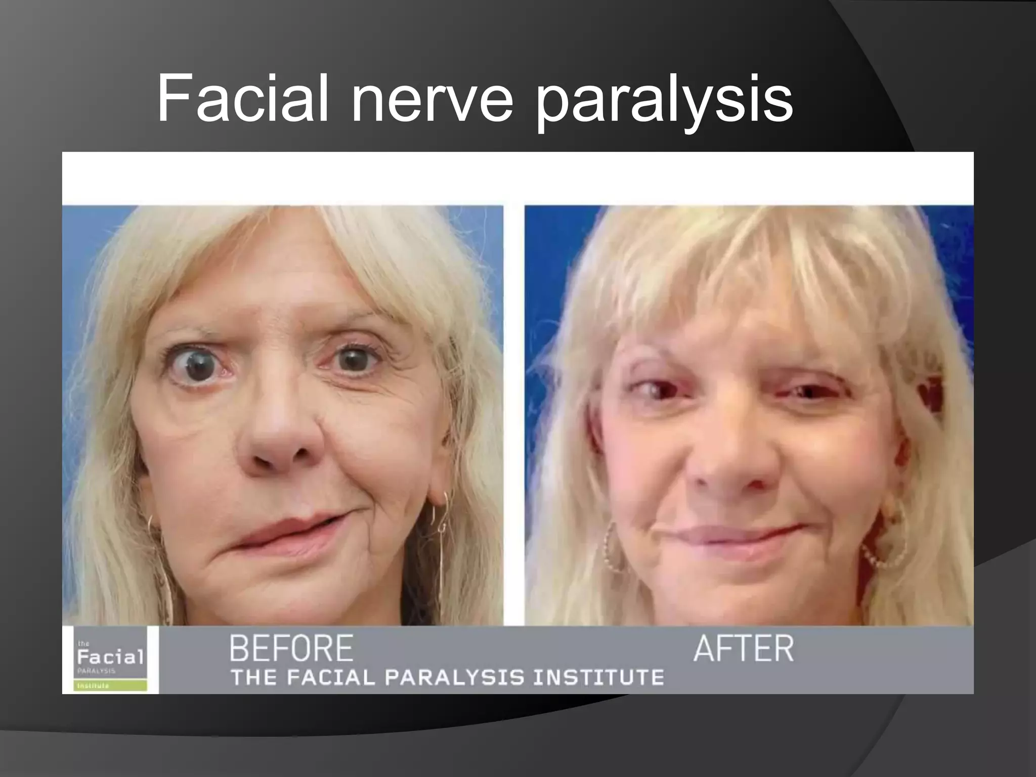 Prognostic test in facial nerve palsy in( ENT ) | PPTX
