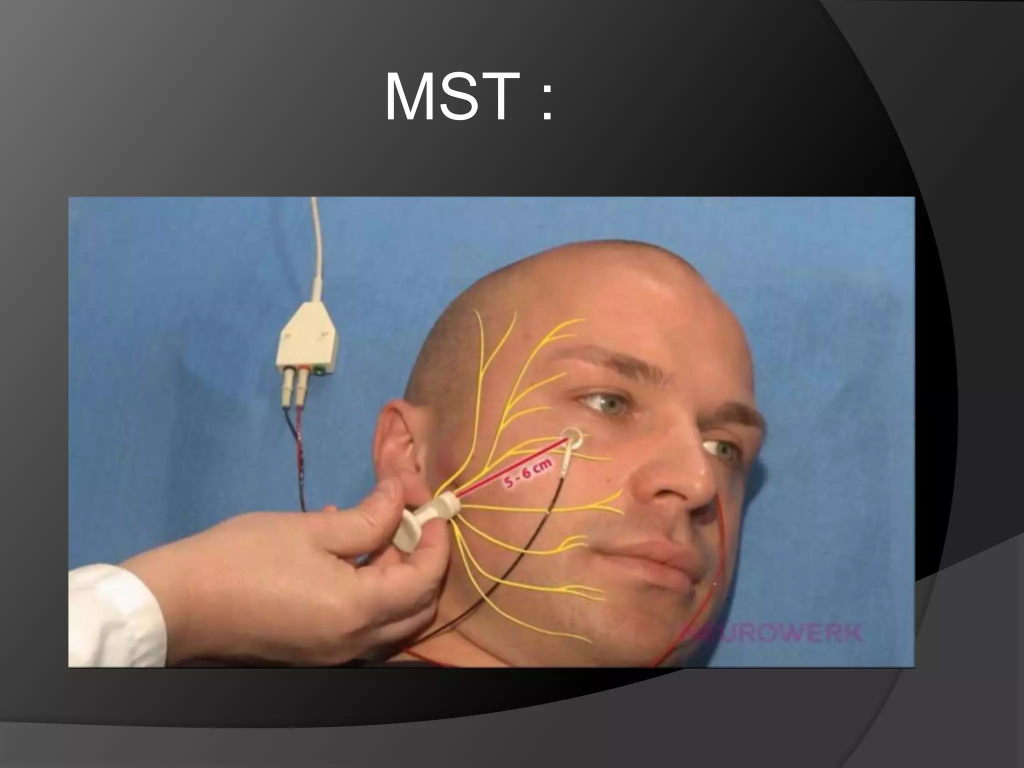 Prognostic test in facial nerve palsy in( ENT ) | PPTX