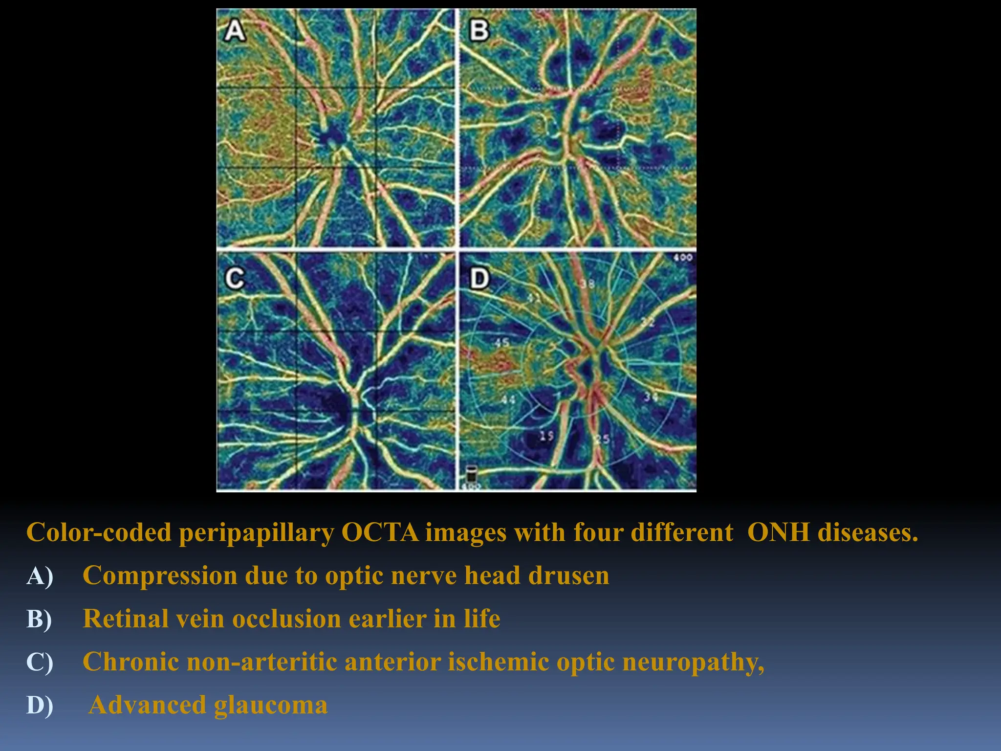 Prognostic value of multiple differential diagnosis of ONH by OCT Angio ...