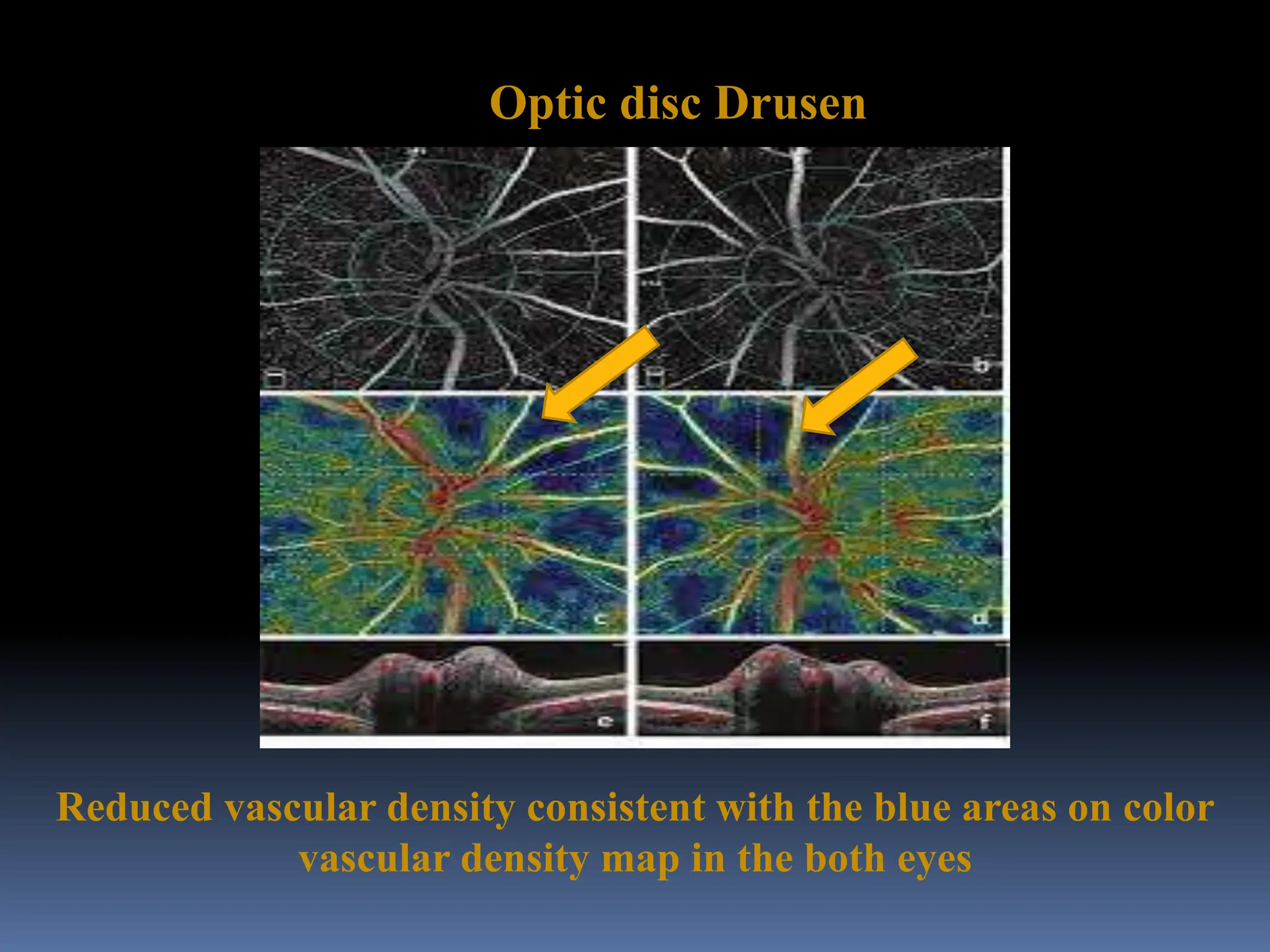 Prognostic value of multiple differential diagnosis of ONH by OCT Angio ...