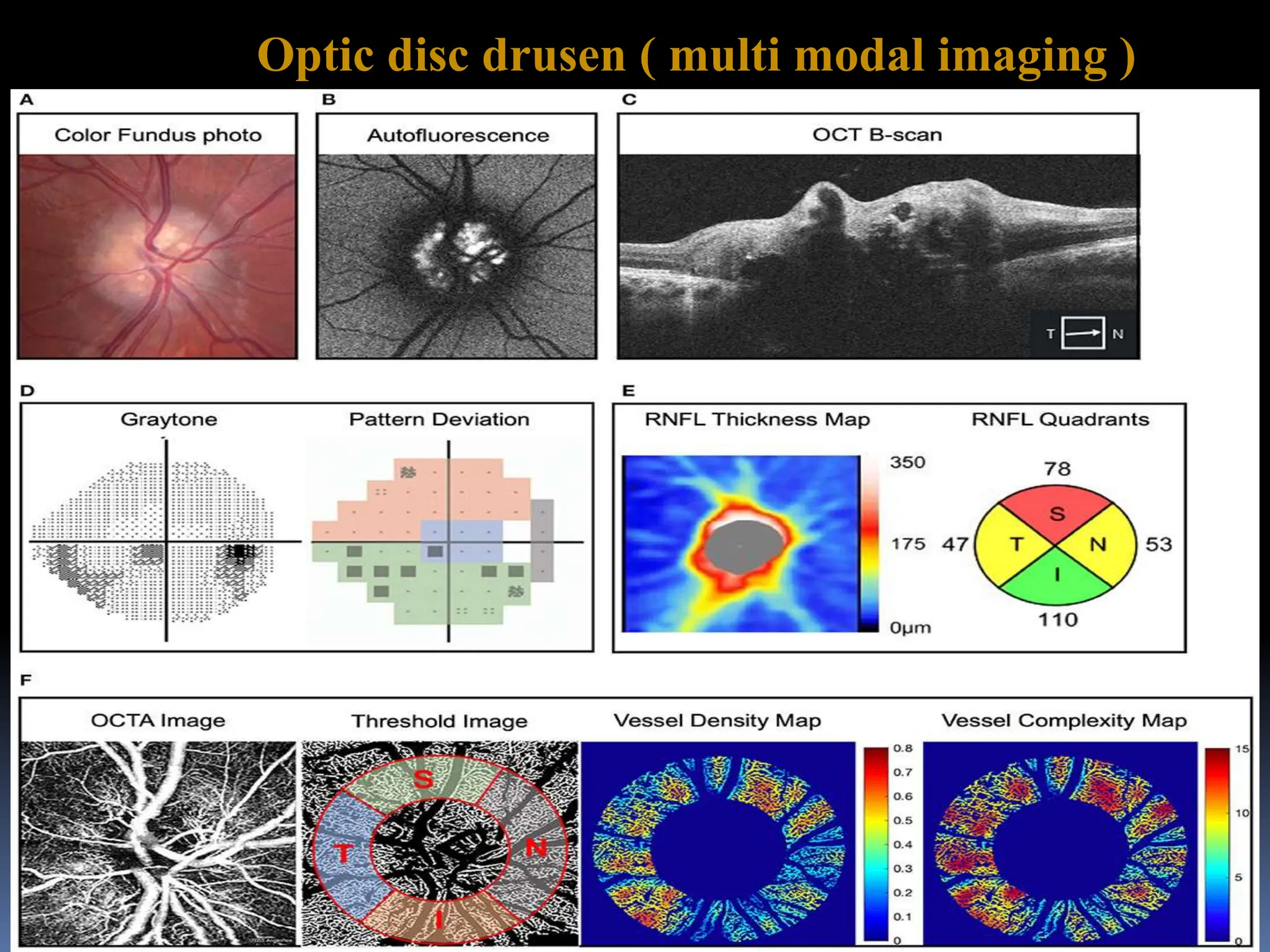 Prognostic value of multiple differential diagnosis of ONH by OCT Angio ...