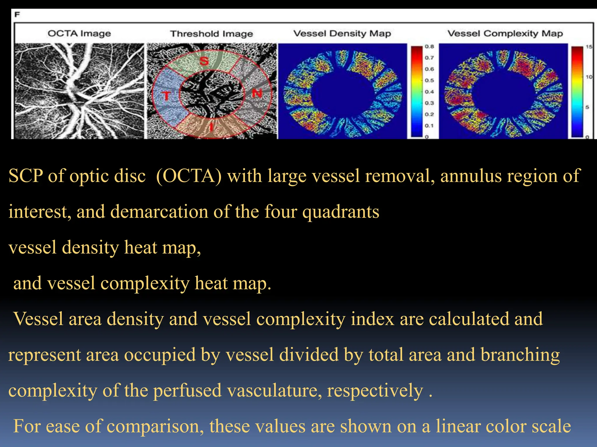 Prognostic value of multiple differential diagnosis of ONH by OCT Angio ...