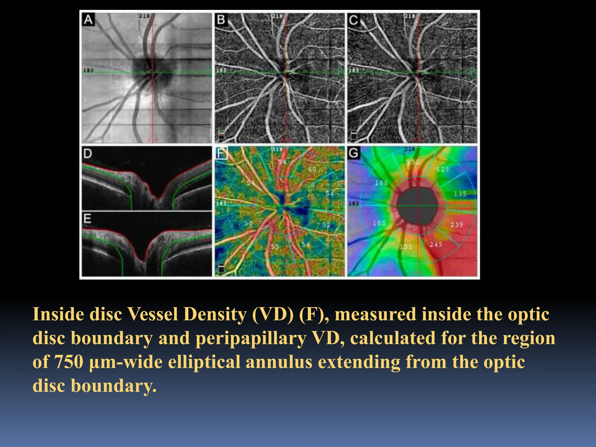 Prognostic value of multiple differential diagnosis of ONH by OCT Angio ...