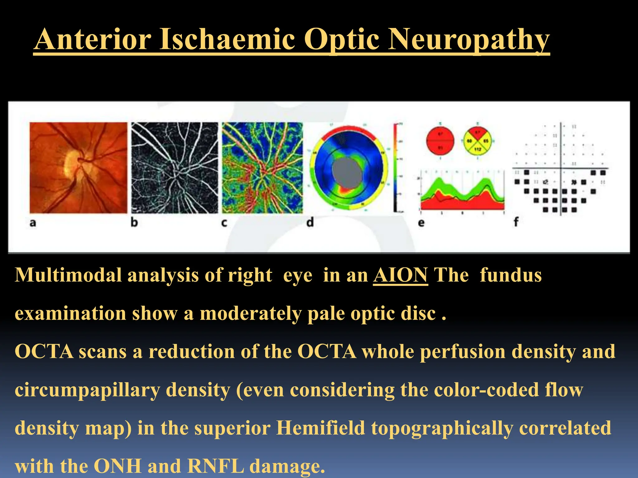 Prognostic value of multiple differential diagnosis of ONH by OCT Angio ...