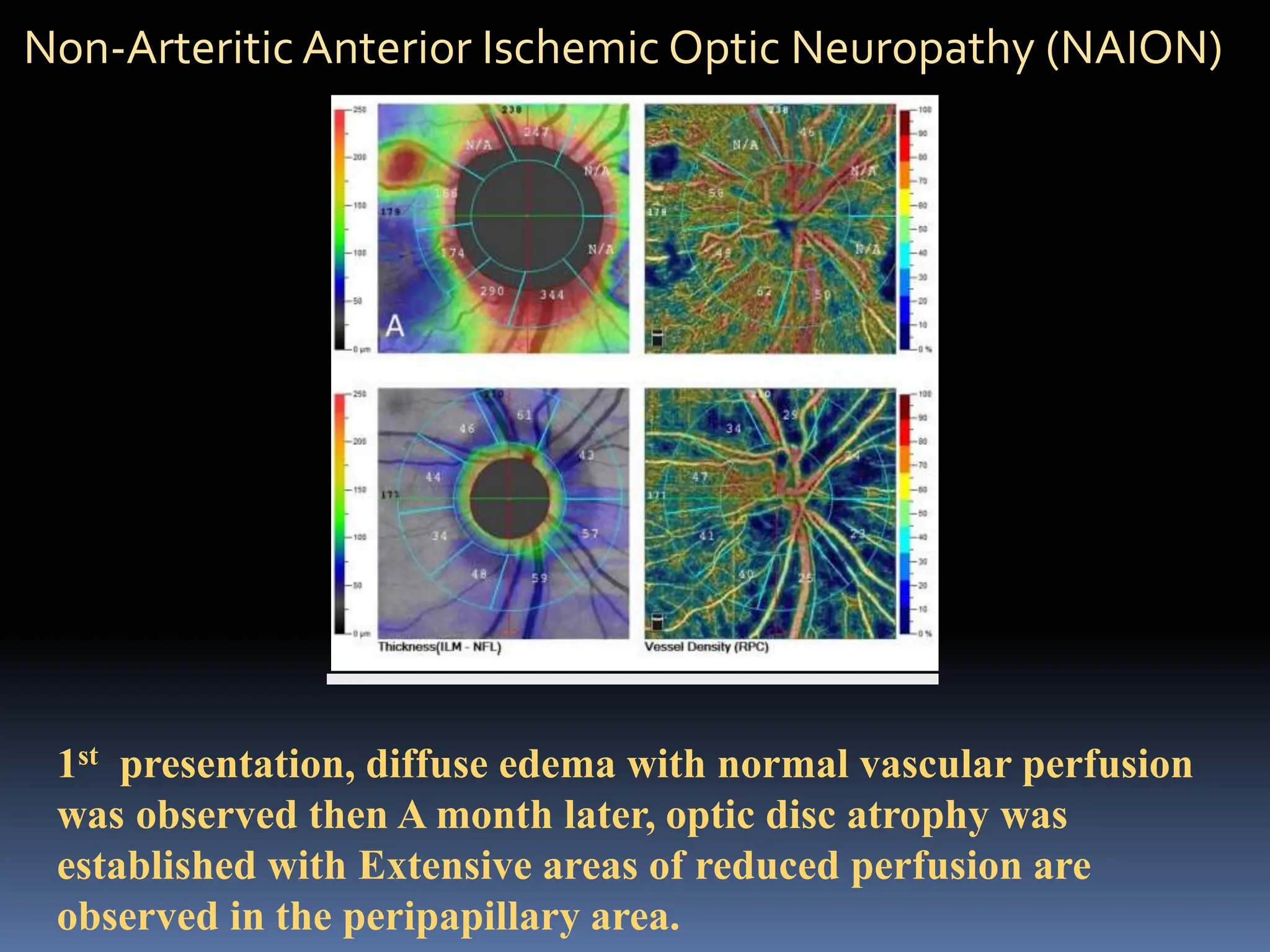 Prognostic value of multiple differential diagnosis of ONH by OCT Angio ...