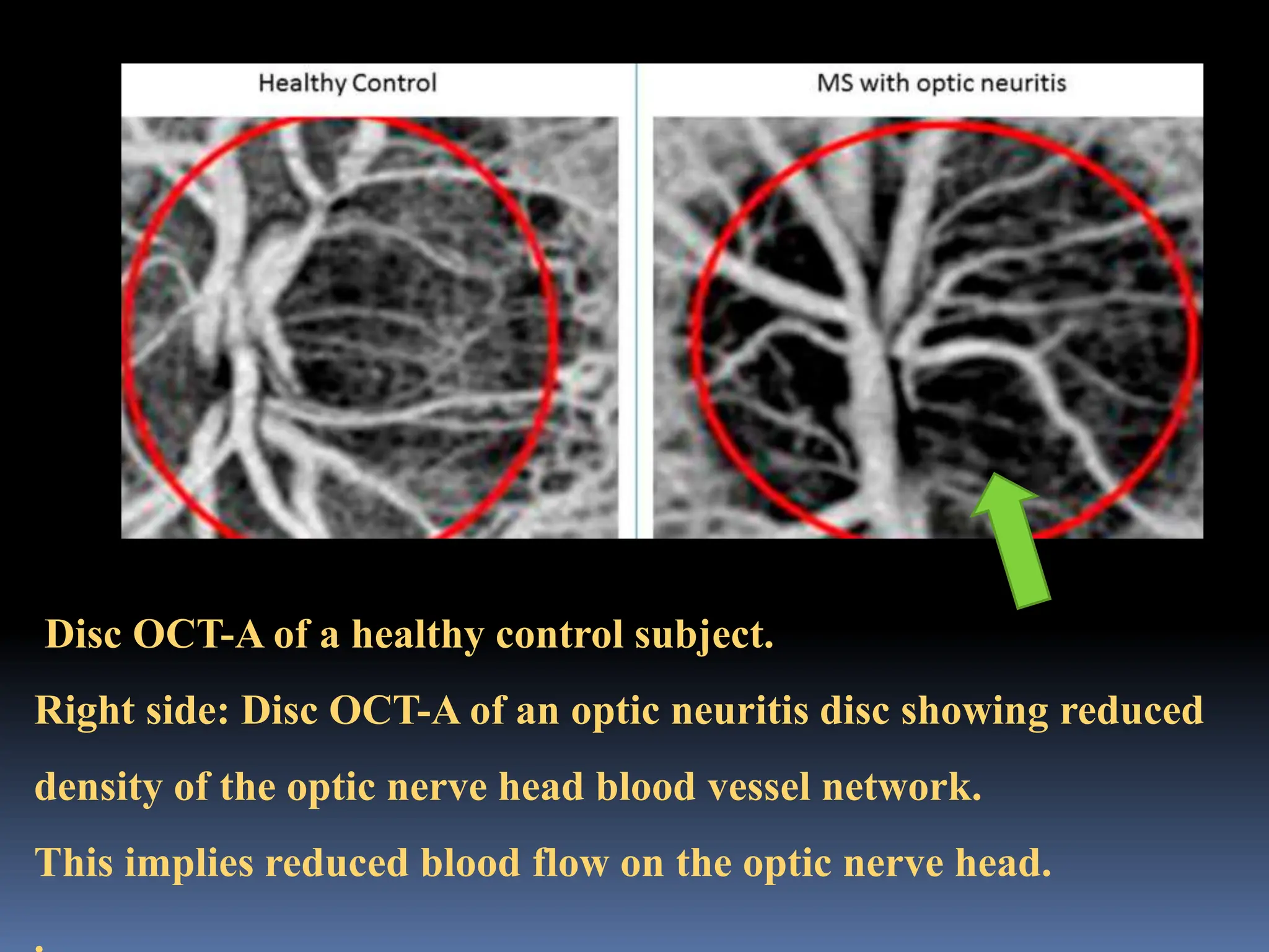 Prognostic value of multiple differential diagnosis of ONH by OCT Angio ...