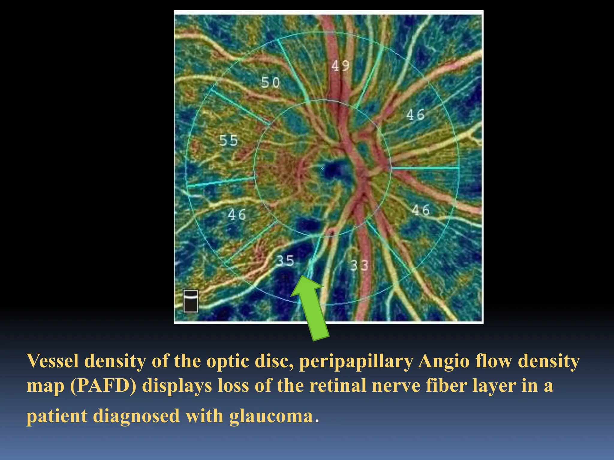 Prognostic value of multiple differential diagnosis of ONH by OCT Angio ...