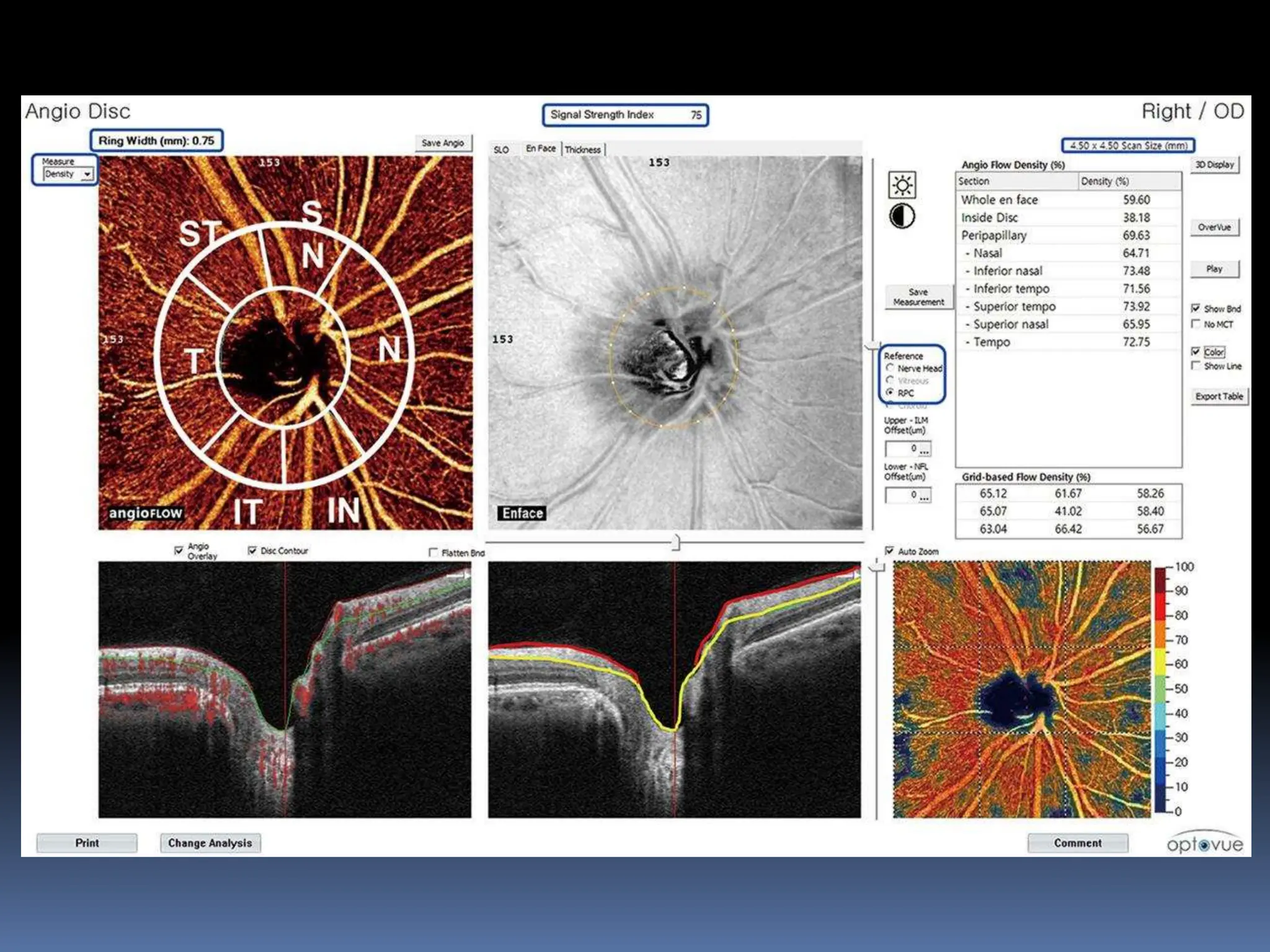 Prognostic value of multiple differential diagnosis of ONH by OCT Angio ...