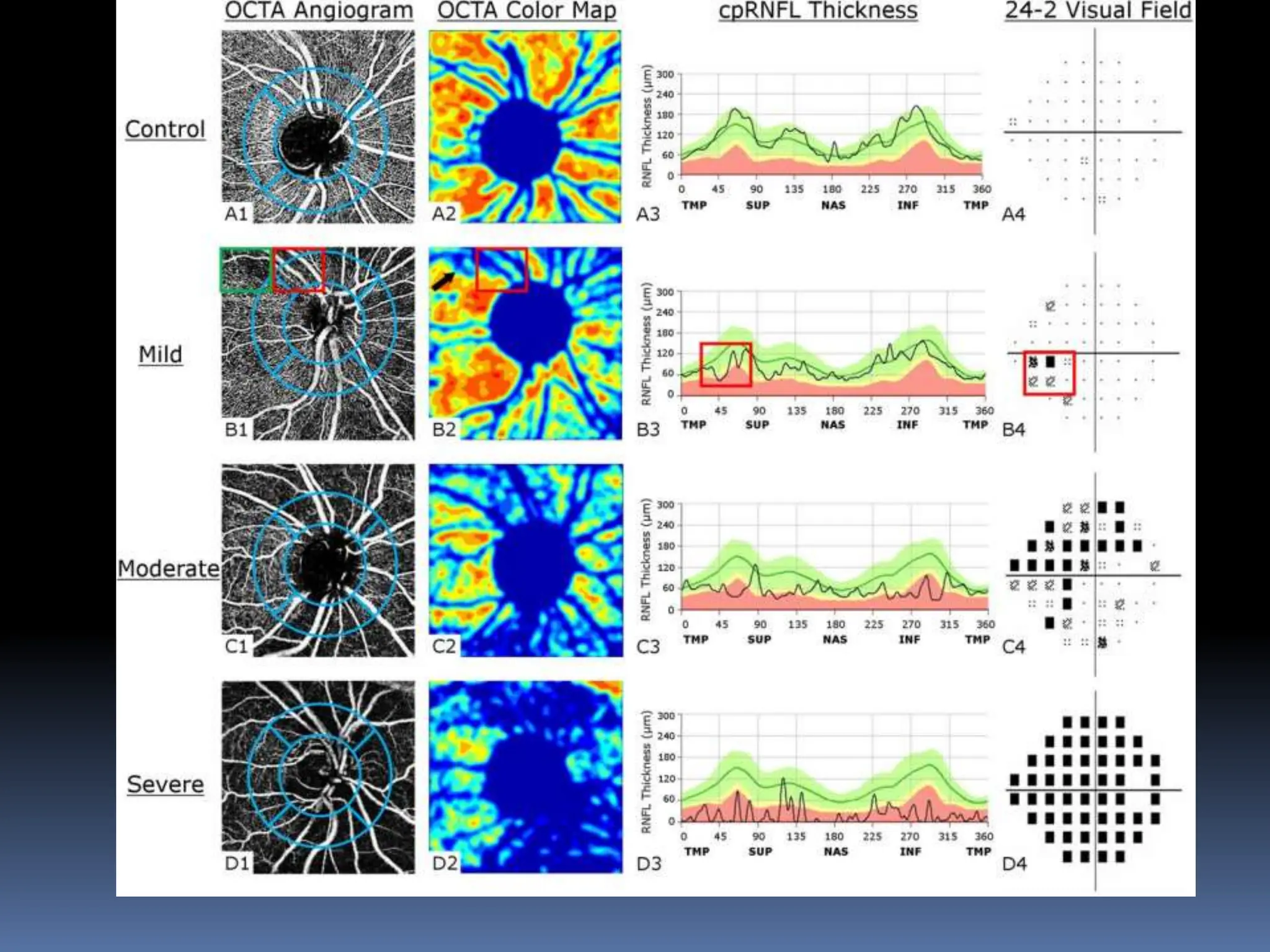 Prognostic value of multiple differential diagnosis of ONH by OCT Angio ...