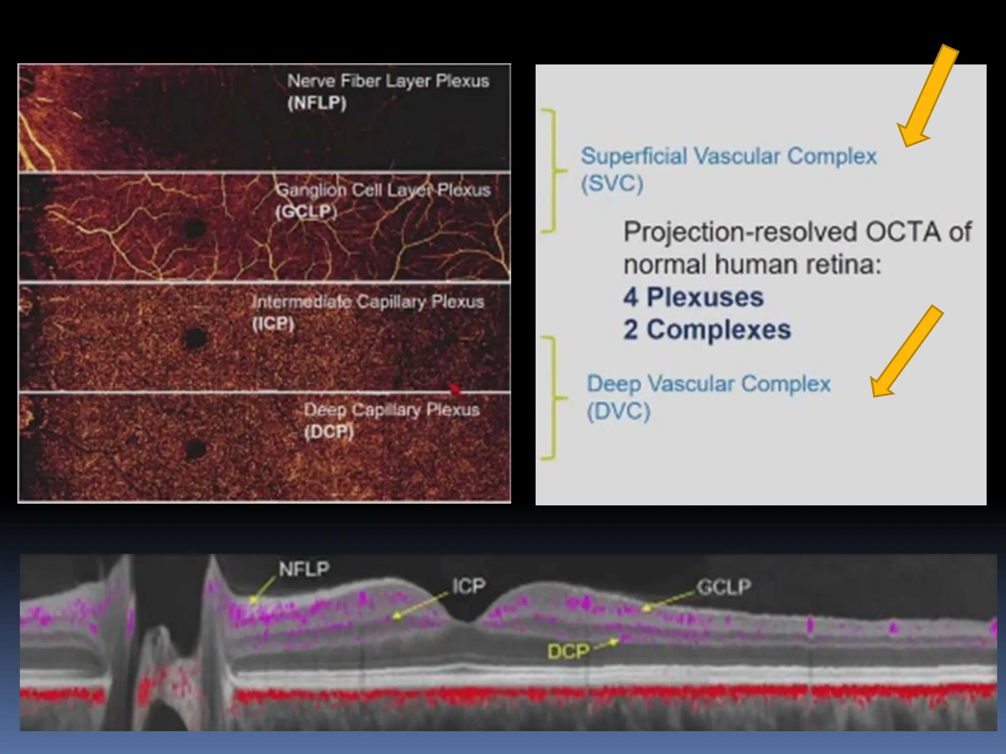 Prognostic value of multiple differential diagnosis of ONH by OCT Angio ...
