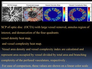 Prognostic value of multiple differential diagnosis of ONH by OCT Angio ...