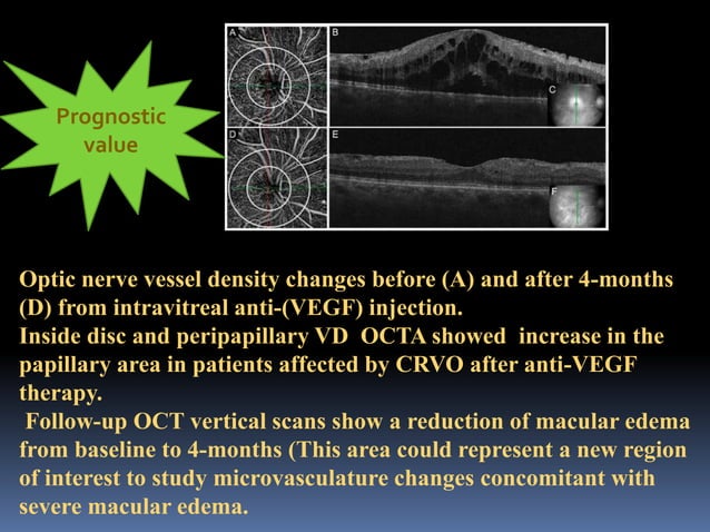Prognostic value of multiple differential diagnosis of ONH by OCT Angio ...