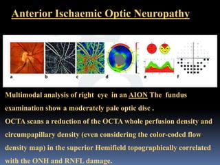 Prognostic value of multiple differential diagnosis of ONH by OCT Angio ...