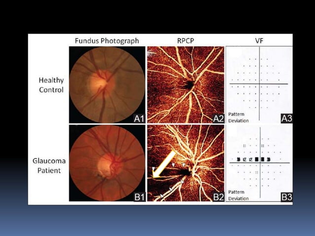Prognostic value of multiple differential diagnosis of ONH by OCT Angio ...