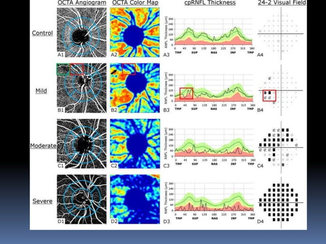 Prognostic value of multiple differential diagnosis of ONH by OCT Angio ...