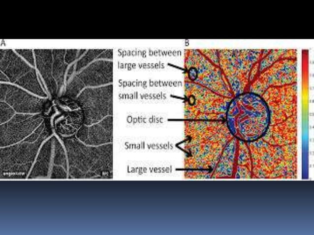 Prognostic value of multiple differential diagnosis of ONH by OCT Angio ...