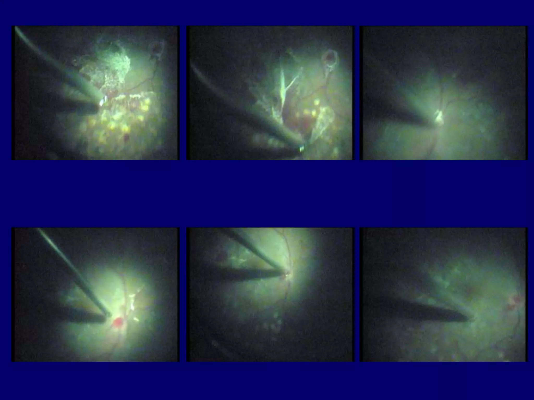 WHAT WE SHOULD DO FOR PROGRESSIVE COMPLICATIONS OF PDR INSPITE OF ...