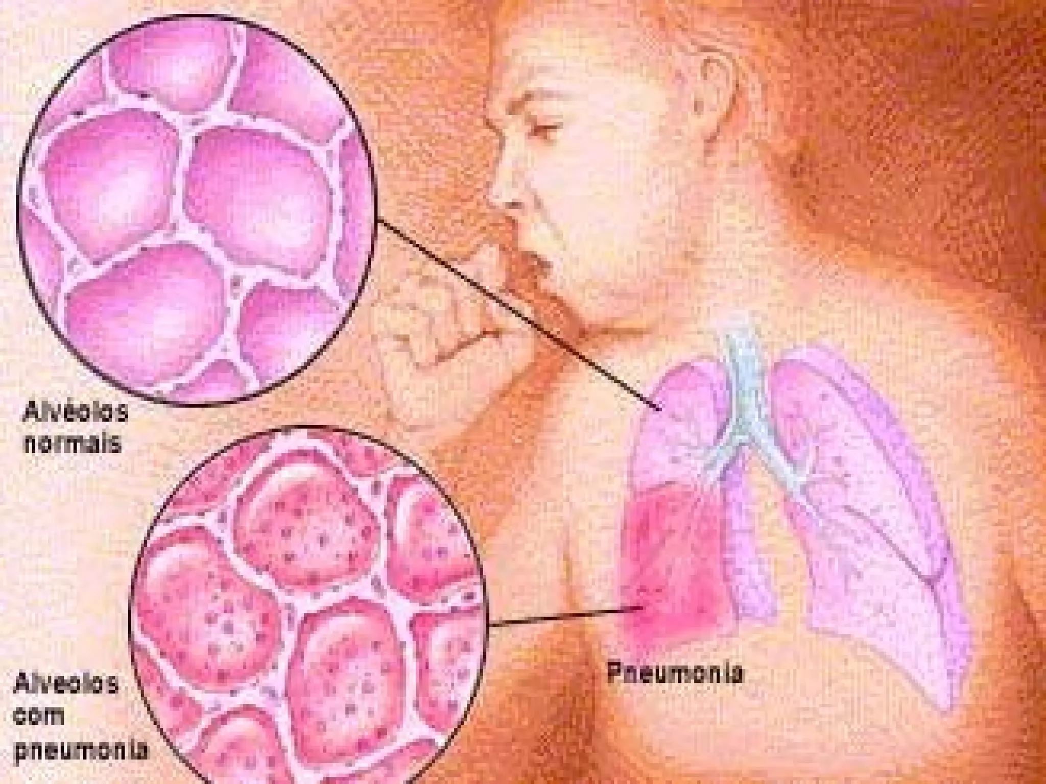 Program ispa di puskesmas | PPT