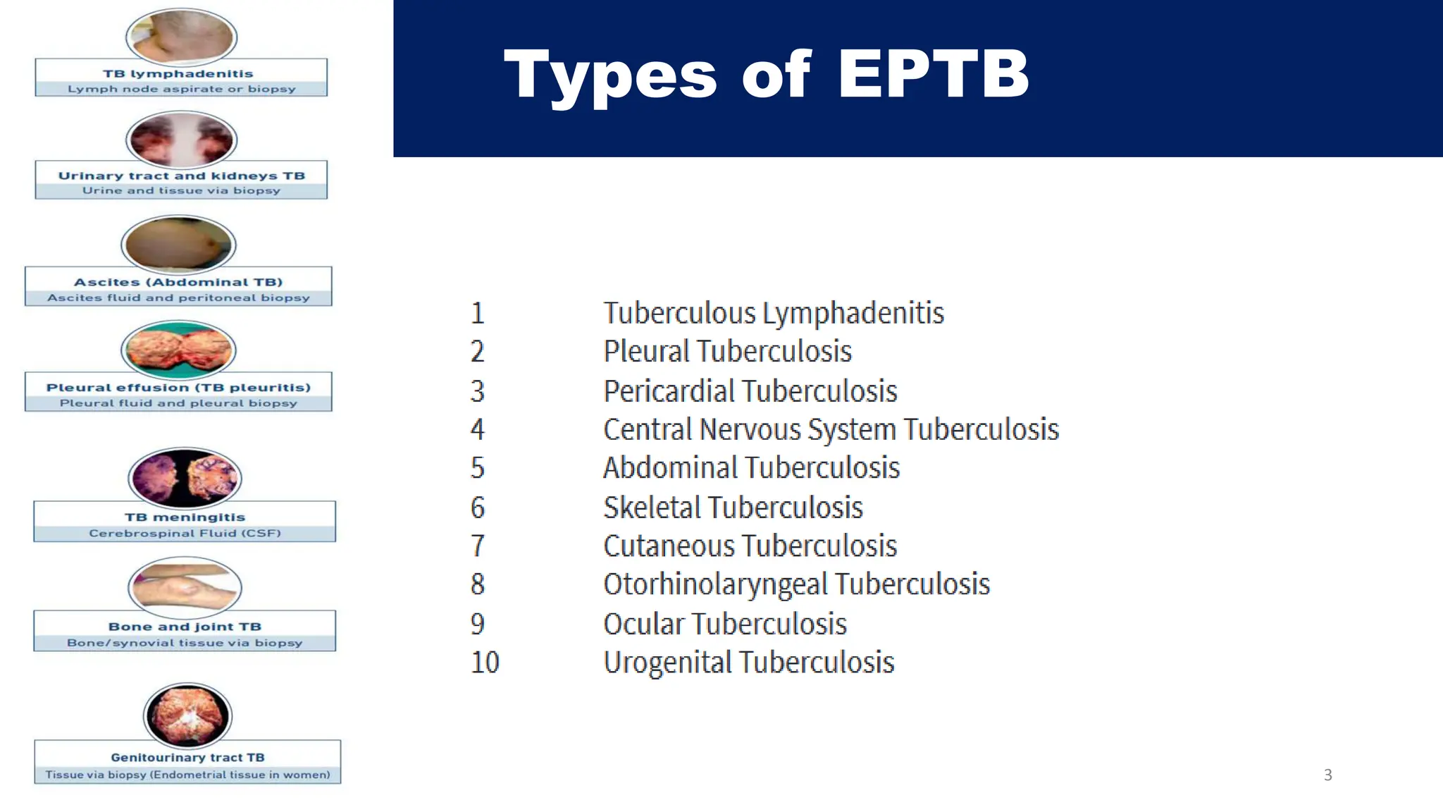 PROGRAMMATIC MANAGEMENT OF EXTRA-PULMONARY TUBERCULOSIS(EPTB).pptx