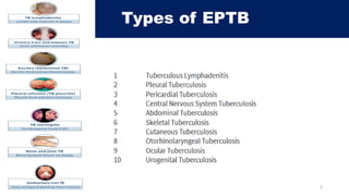 PROGRAMMATIC MANAGEMENT OF EXTRA-PULMONARY TUBERCULOSIS(EPTB).pptx