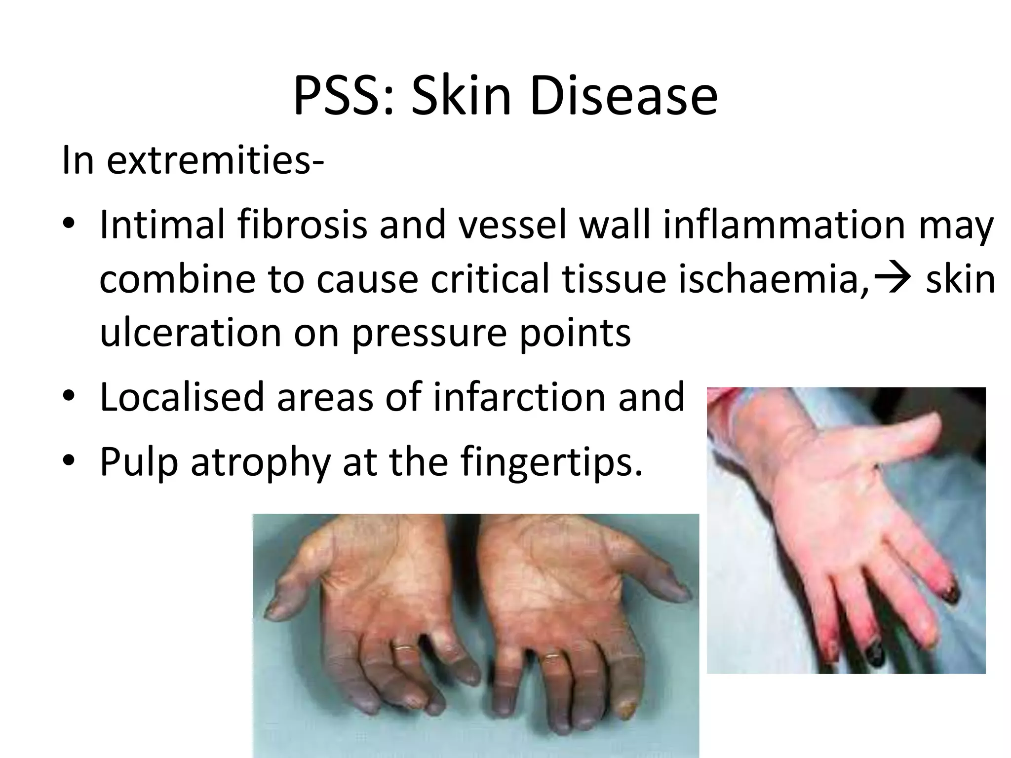 Progresive systemic sclerosis | PPTX