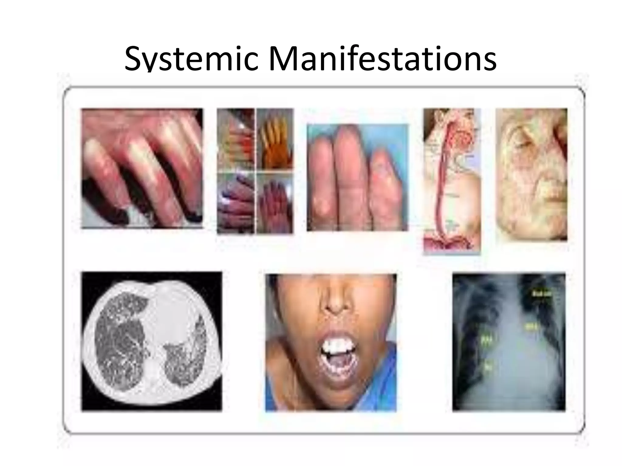 Progresive systemic sclerosis | PPTX