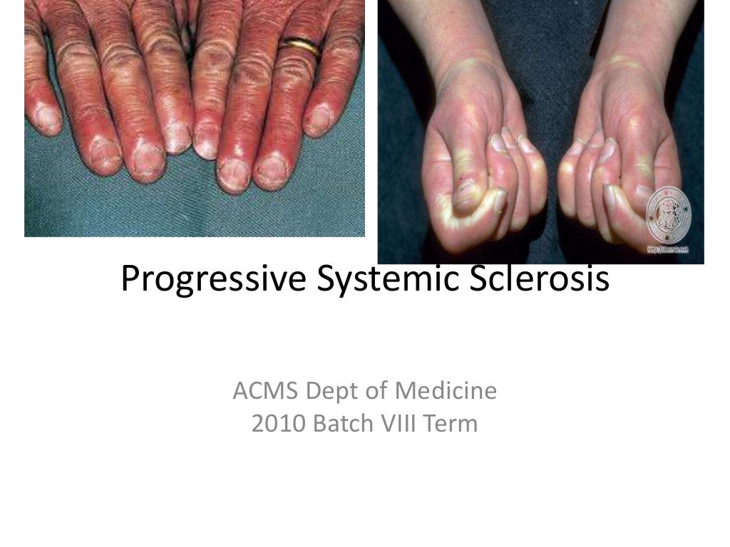 Progresive systemic sclerosis