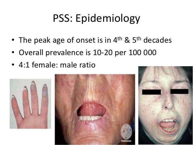 Progresive systemic sclerosis