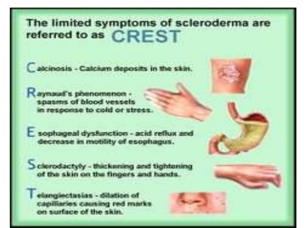 Progresive systemic sclerosis
