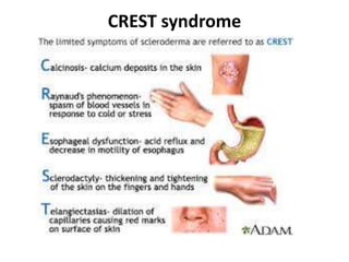 Sclerodactyly Telangiectasia