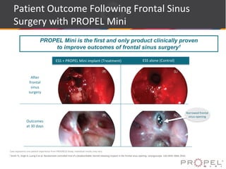 PROGRESS Study: PROPEL Mini Steroid Releasing Implant | PDF