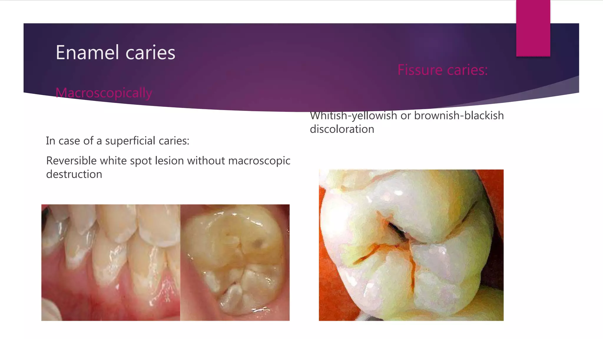 Progression oEnamel caries | PPTX | Dental Health | Diseases and Conditions